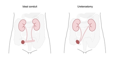 What is a Stoma? Stoma Function and Types Explained | B. Braun ...