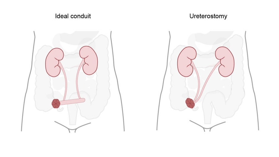What is a Stoma? Stoma Function and Types Explained | B. Braun ...