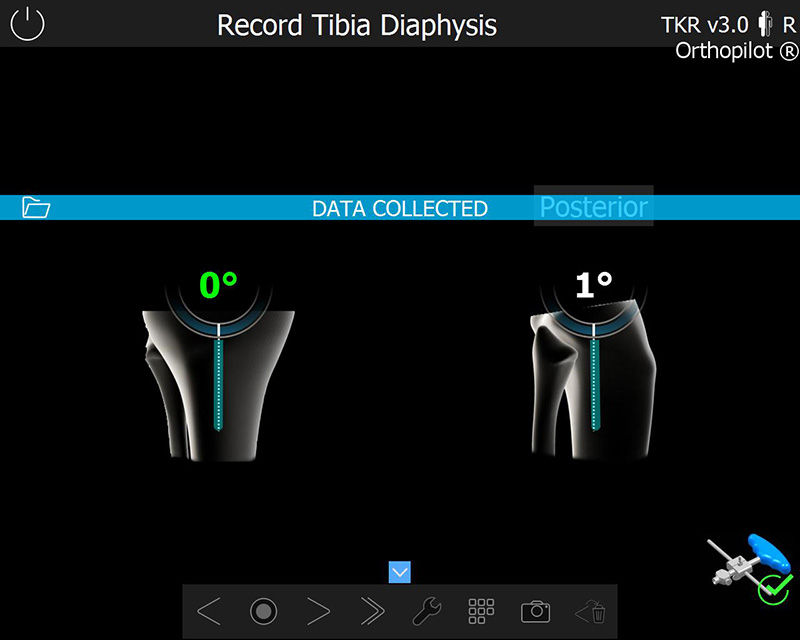 Total Knee Revision (TKR) - B. Braun