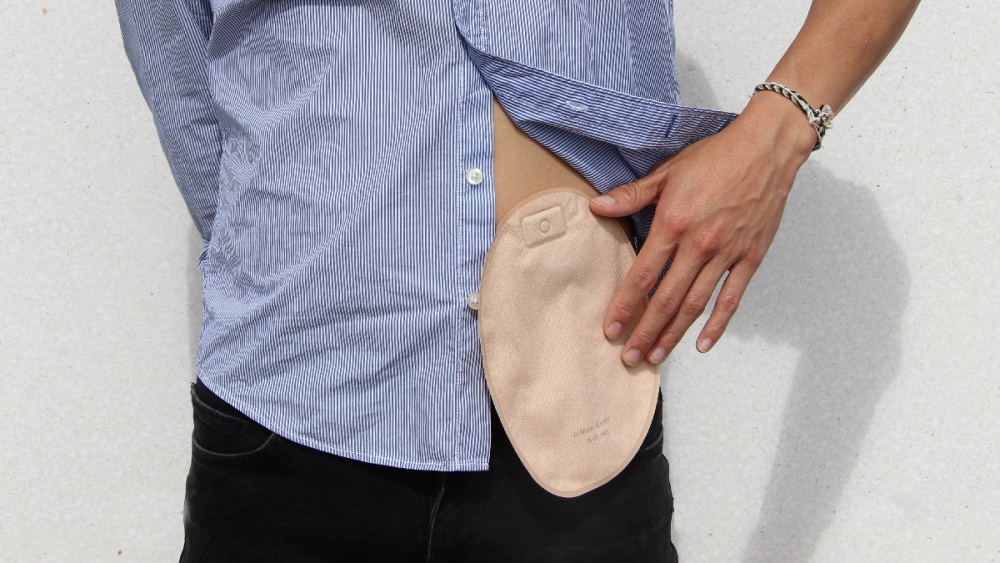 What is a Stoma? Stoma Function and Types Explained | B. Braun ...