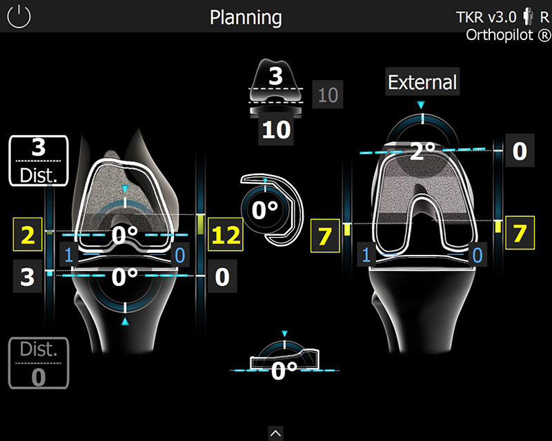 Total Knee Revision (TKR) - B. Braun