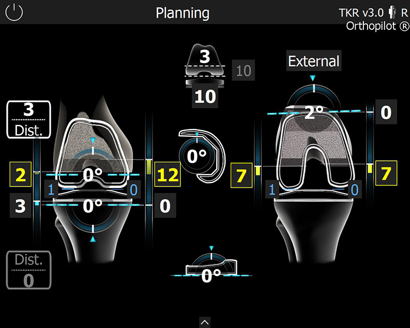 Total Knee Revision (TKR) - B. Braun