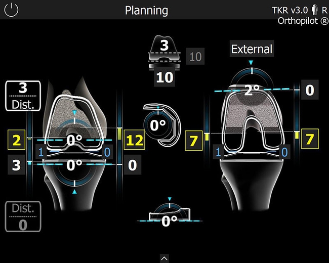 Total Knee Revision (TKR) - B. Braun