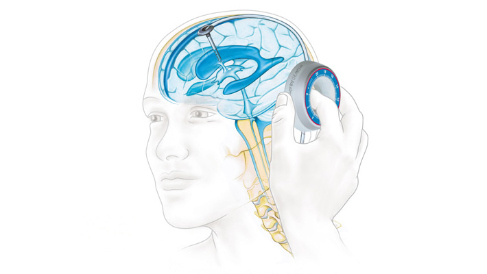 Understanding Hydrocephalus | B. Braun Australia - B. Braun