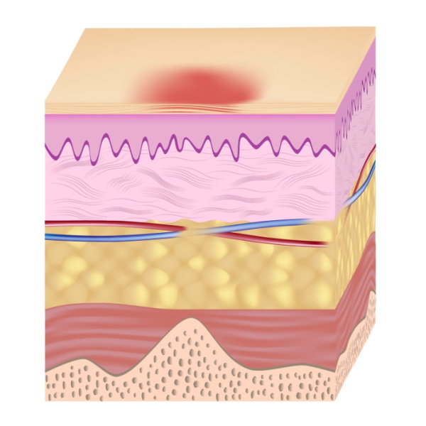 Pressure injury treatment | B. Braun Australia - B. Braun