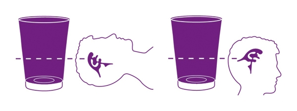 Treating Hydrocephalus | B. Braun Australia - B. Braun