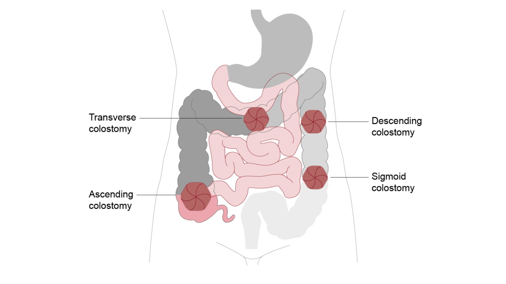 What is a Stoma? Stoma Function and Types Explained | B. Braun ...