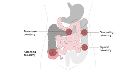What is a Stoma? Stoma Function and Types Explained | B. Braun ...