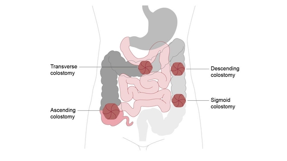 What is a Stoma? Stoma Function and Types Explained | B. Braun ...