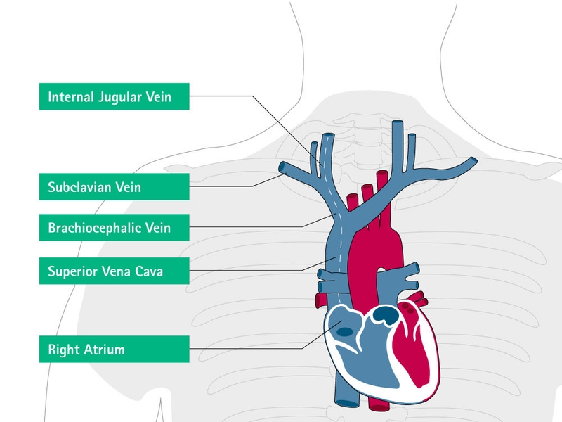 Misplacement and Malposition of Central Venous Catheters | B. Braun ...
