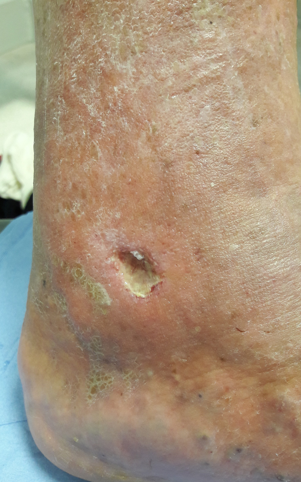Wound Hygiene Stage 2 | B. Braun Australia - B. Braun
